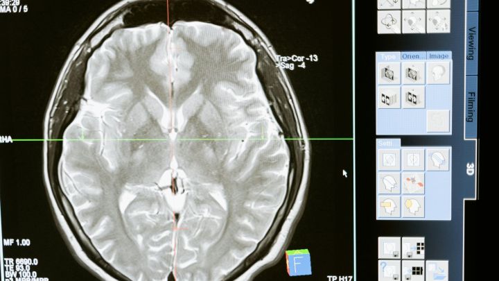 Encefalite: porque é que o tratamento precoce é importante